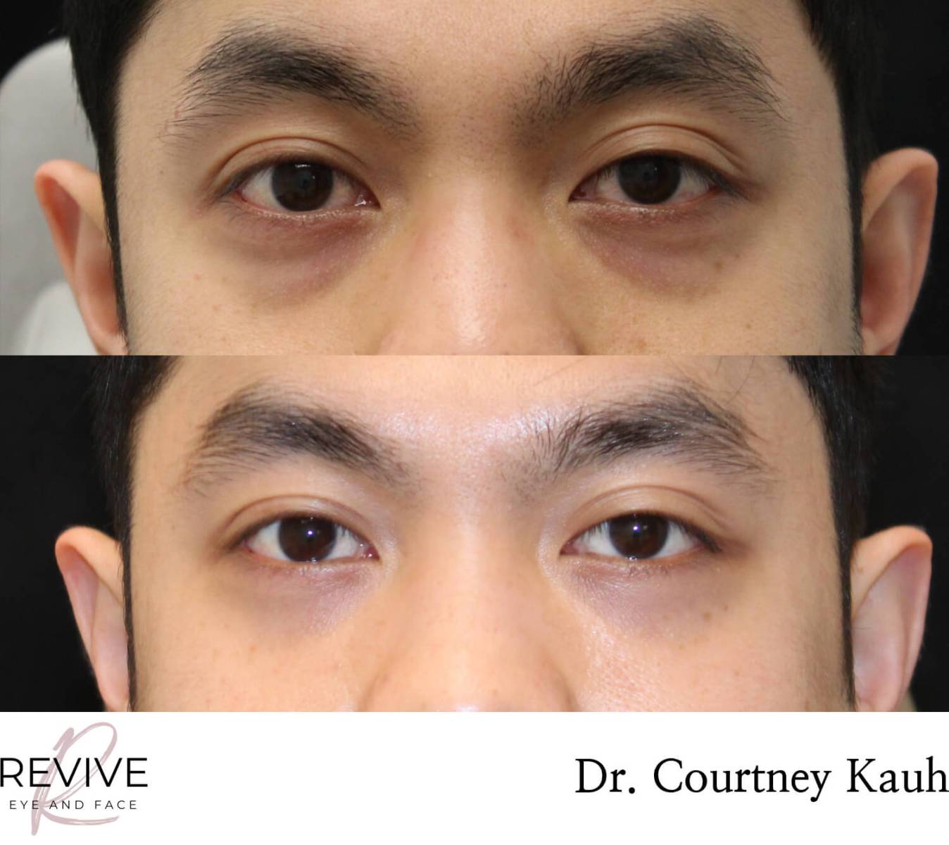 Lower Blepharoplasty | Revive Eye and Face