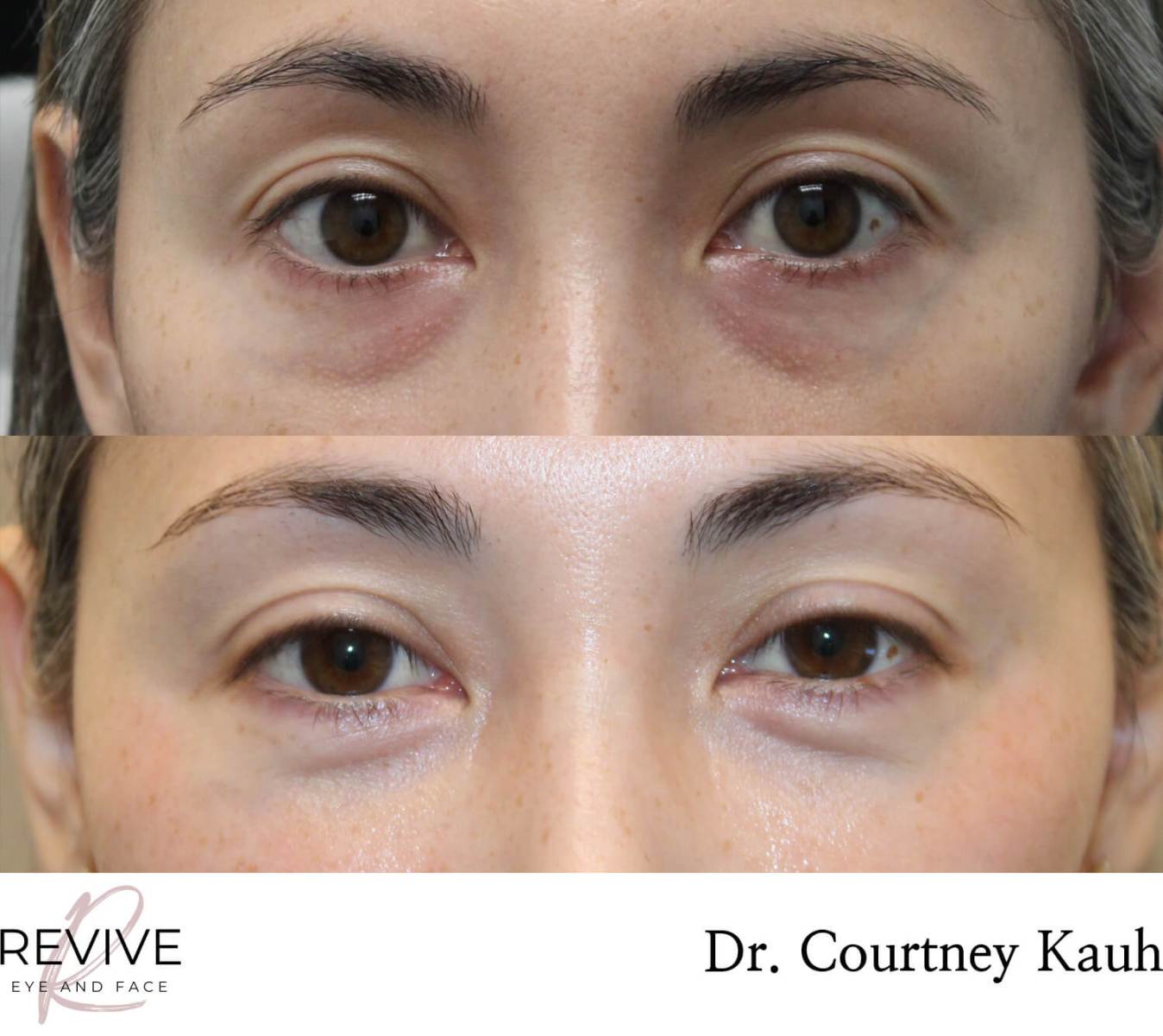 Lower Blepharoplasty | Revive Eye and Face