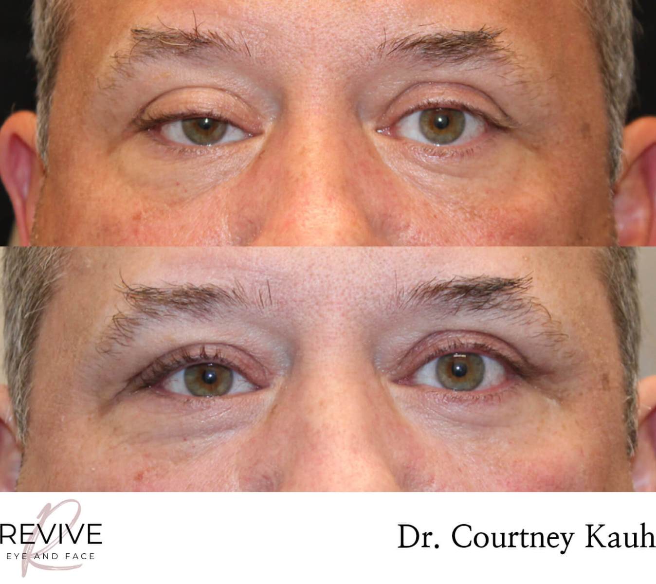 Before and After Ptosis Photos | Revive Eye and Face