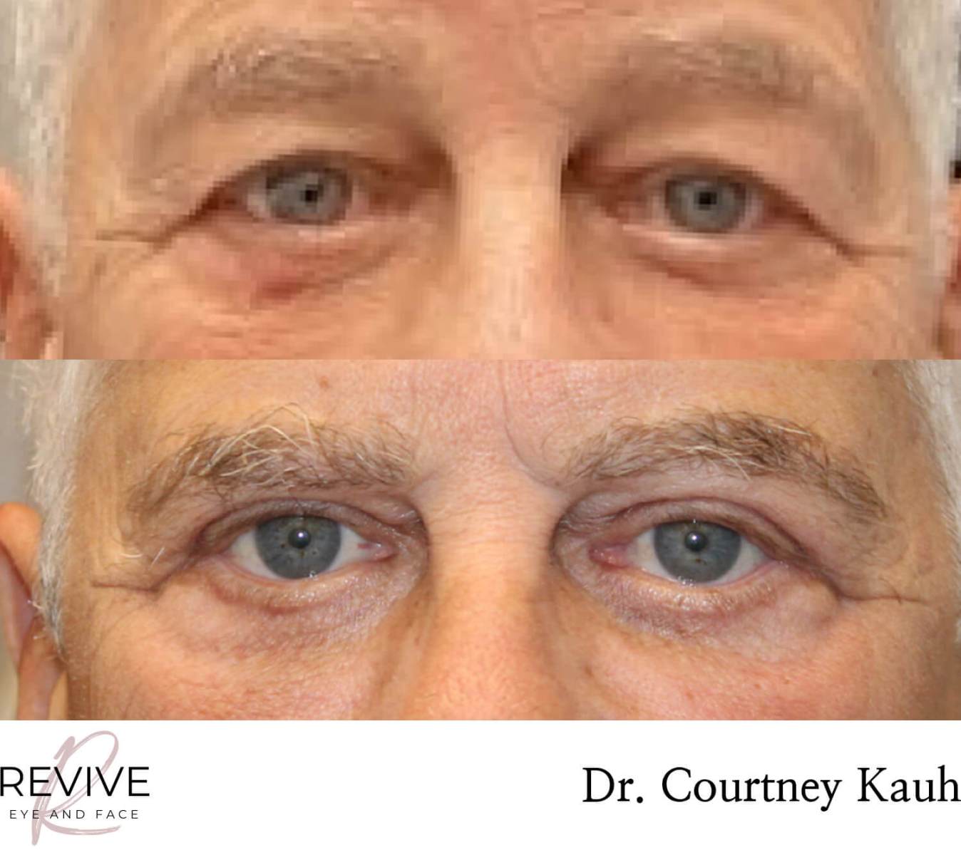Ptosis | CK Eyelid Plastic Surgery