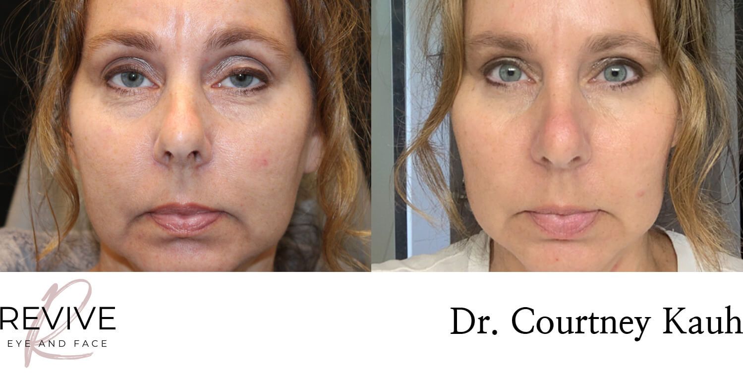 Before and After Ptosis Photos | Revive Eye and Face