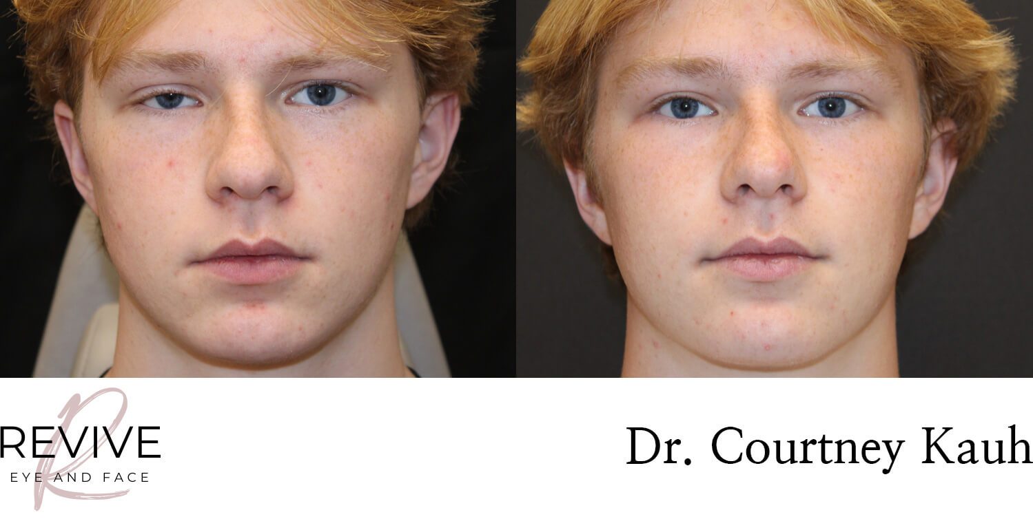 Before and After Ptosis Photos | Revive Eye and Face