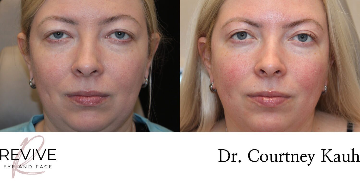 Before and After Ptosis Photos | Revive Eye and Face