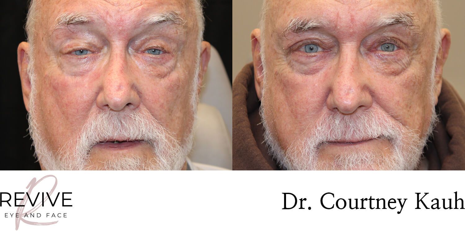 Before and After Ptosis Photos | Revive Eye and Face