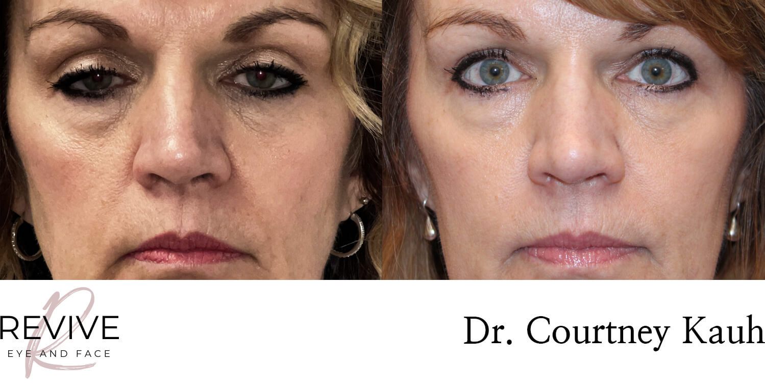 Before and After Ptosis Photos | Revive Eye and Face