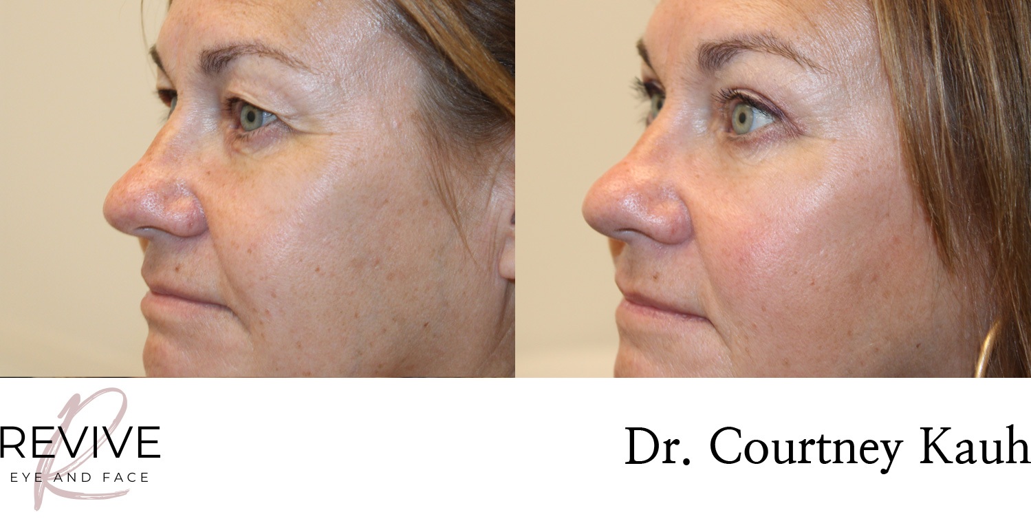 Before and After Upper Eyelid Blepharoplasty Photos | Revive Eye and Face