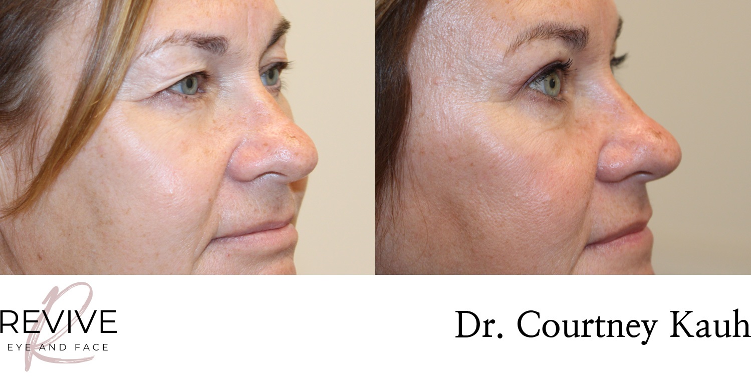 Before and After Upper Eyelid Blepharoplasty Photos | Revive Eye and Face